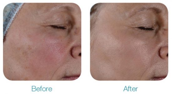 LASER FRACCIONAL NO ABLATIVO AG BIOMEDIC LASER FRACCIONAL NO ABLATIVO AG BIOMEDIC